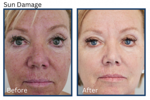 Before and After - Sun Damage - Pymble Dermatology